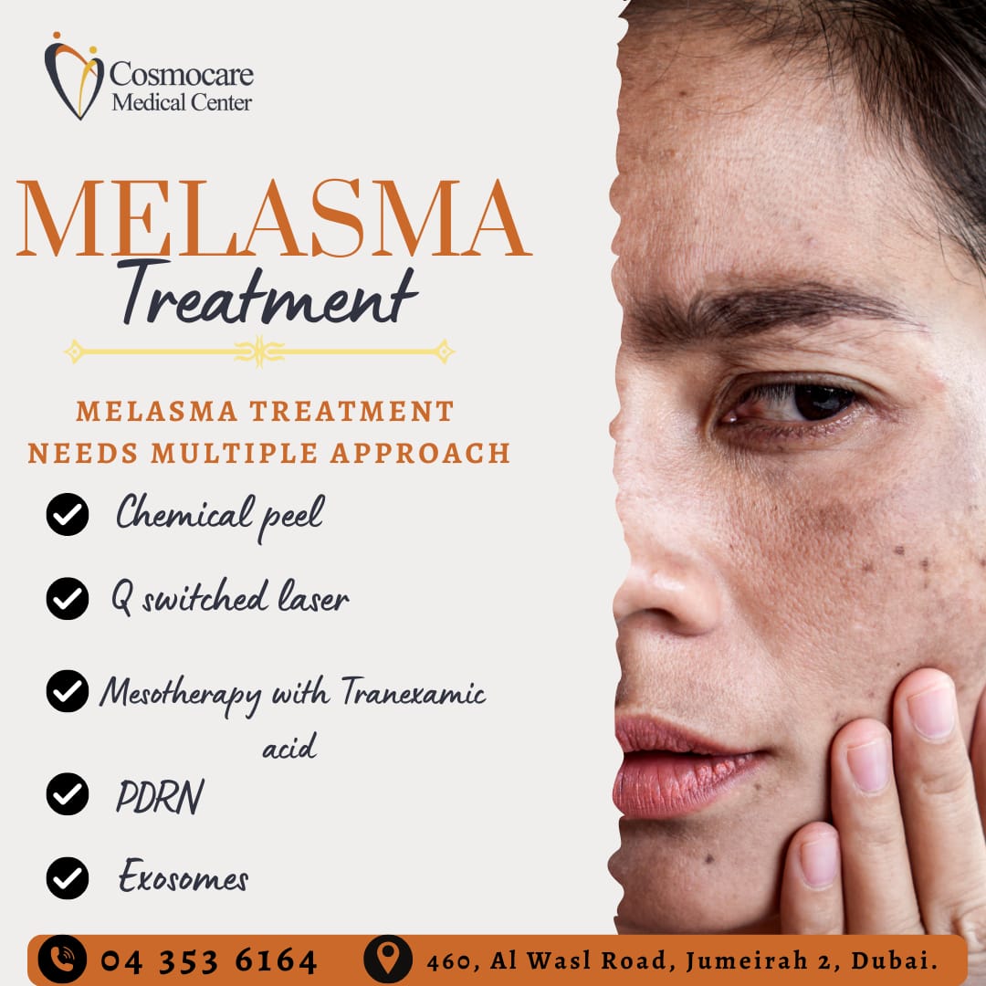 MELASMA TREATMENT - Cosmocare Medical Center