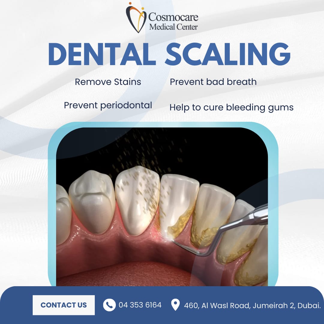 Dental Scaling - Cosmocare Medical Center